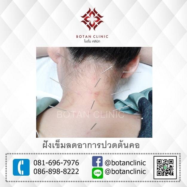รูป Botan Clinic โบตั๋นคลินิก ฝังเข็ม ครอบแก้ว กัวซา ยาจีน วัดตะกล่ำ ...