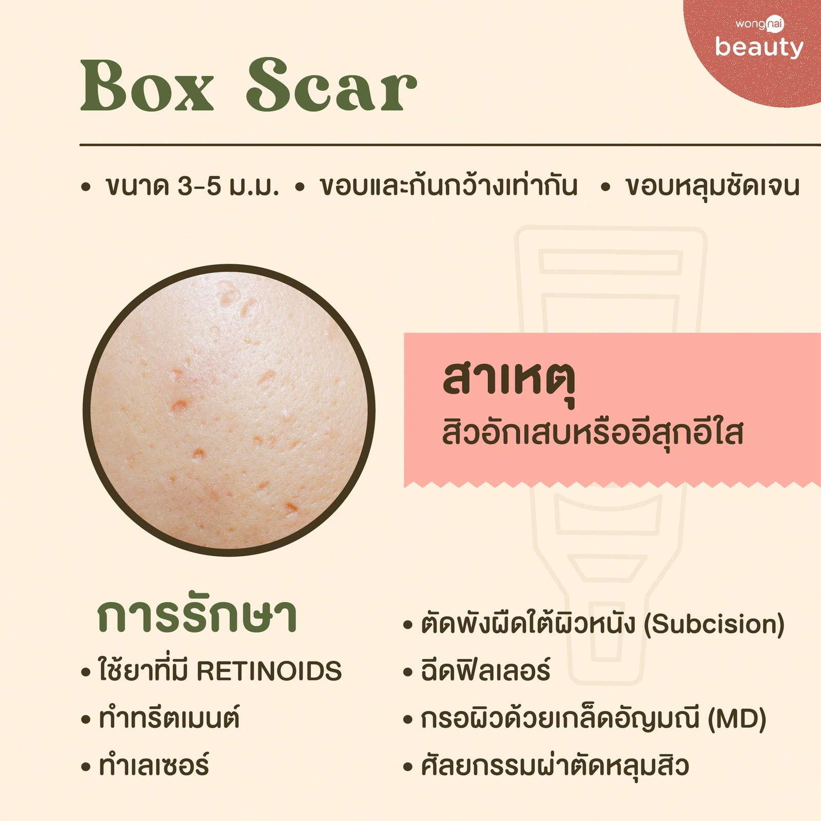 เช็กตัวเอง เรามีหลุมสิวแบบไหน แล้วรักษายังไงดี?