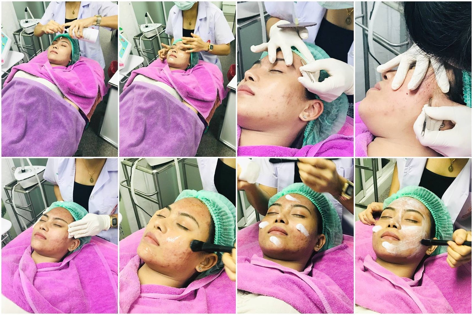 Acne Treatment by Miami Peel • ขั้นตอนการทำ Miami Peel Acne treatment ...