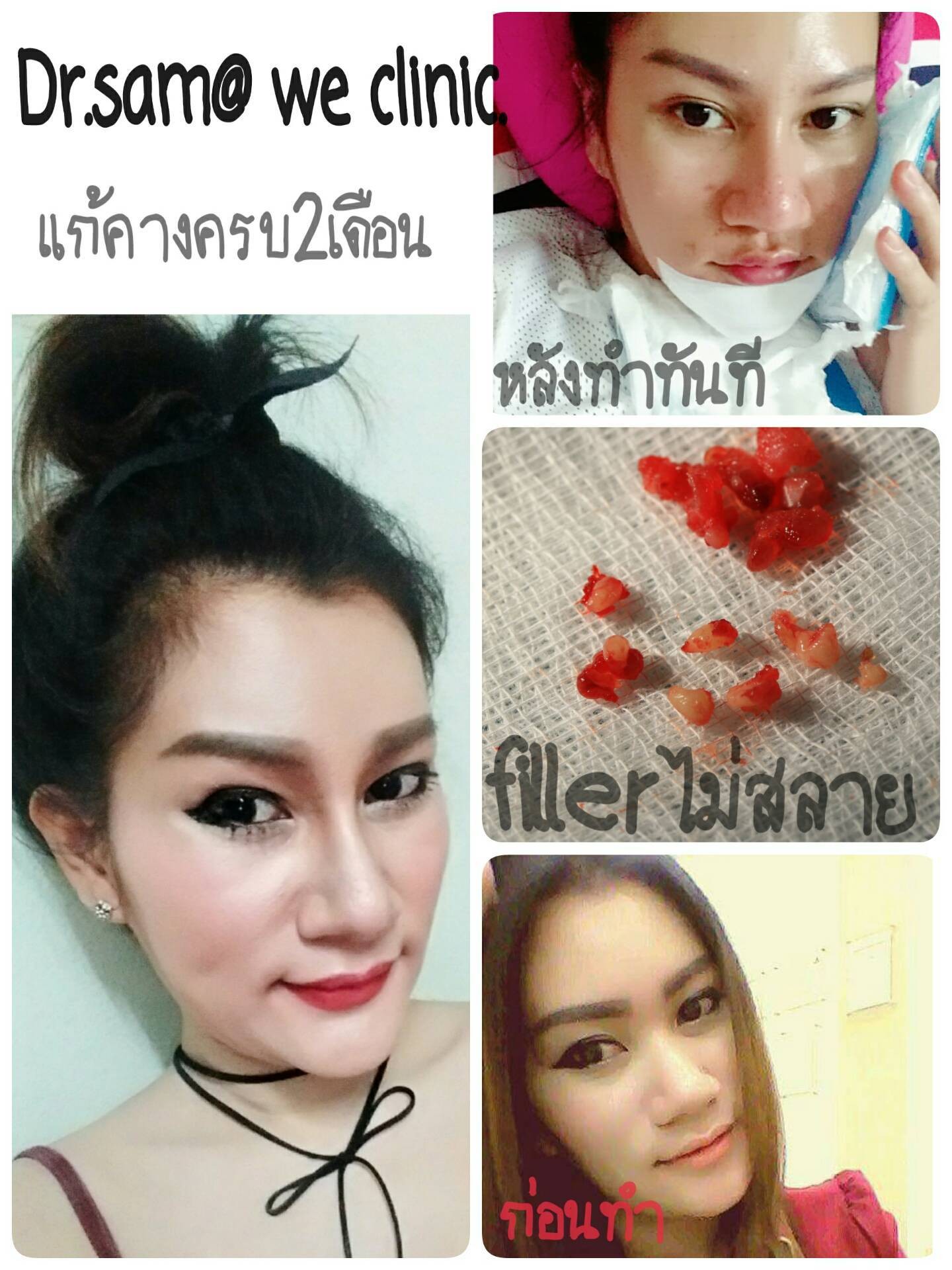 รีวิว WE clinic by หมอแซม หมอดา - แก้คางกับหมอแซมค่ะเคยฉีดฟิลเลอร์4-5ปีมันย้อยเปนก้อนไม่สวย ...