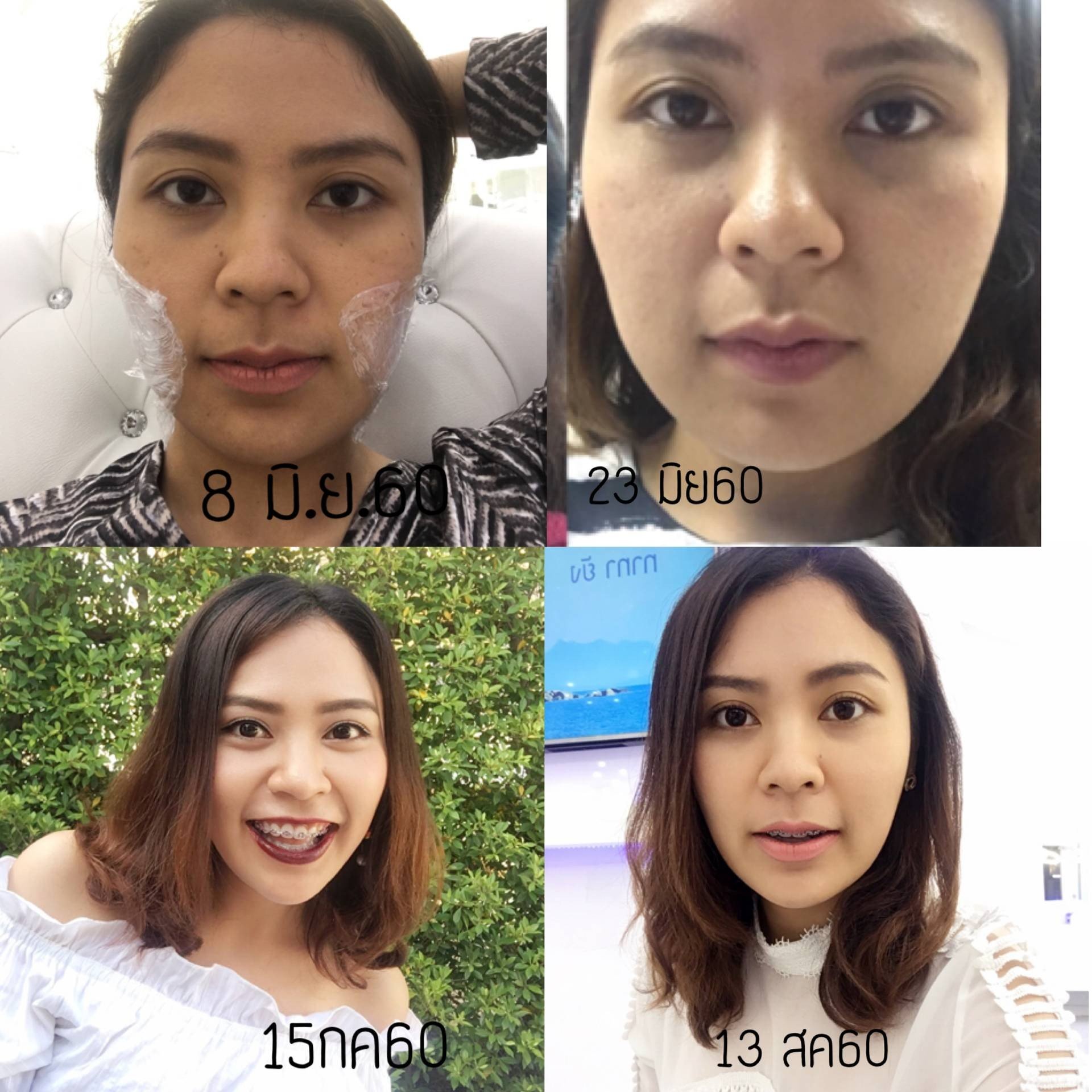 รีวิว V Square Clinic Botox Filler Center Gateway เอกมัย - Review ...