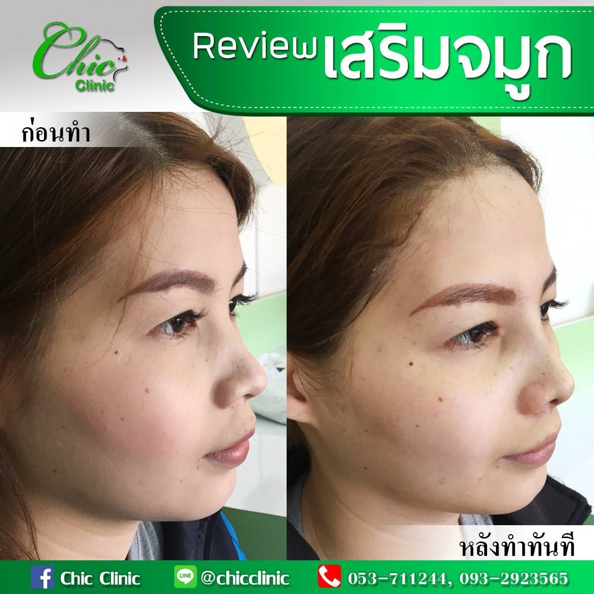 รีวิว Chic Clinic เชียงราย - เสริมจมูกสวย - Wongnai