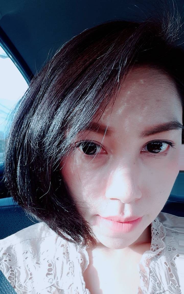 รีวิว V Square Clinic Botox Filler Center The Walk ราชพฤกษ์ - V square ...