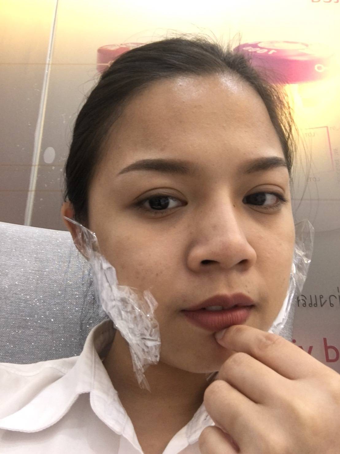 รีวิว V Square Clinic Botox Filler Center Major Ratchayothin - ดูผลหลัง ...