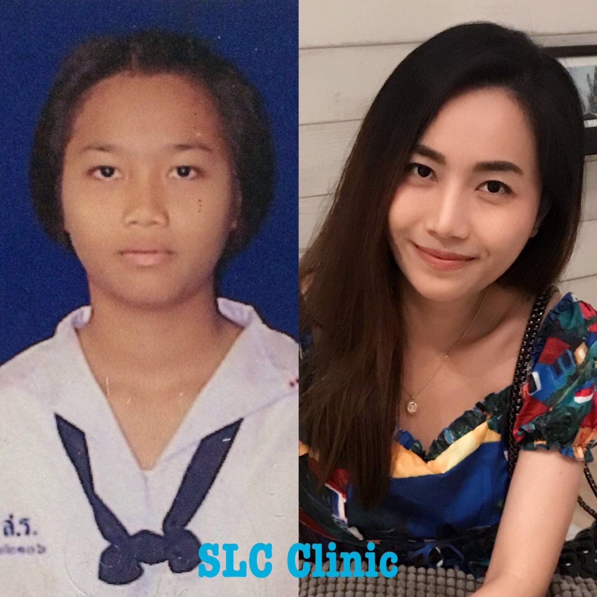 รีวิว SLC Siam Laser Clinic พาราไดซ์ พาร์ค - เสริมจมูก สวยจบ ครบที่นี่ 😘😍 #slcclinic #Peachslc