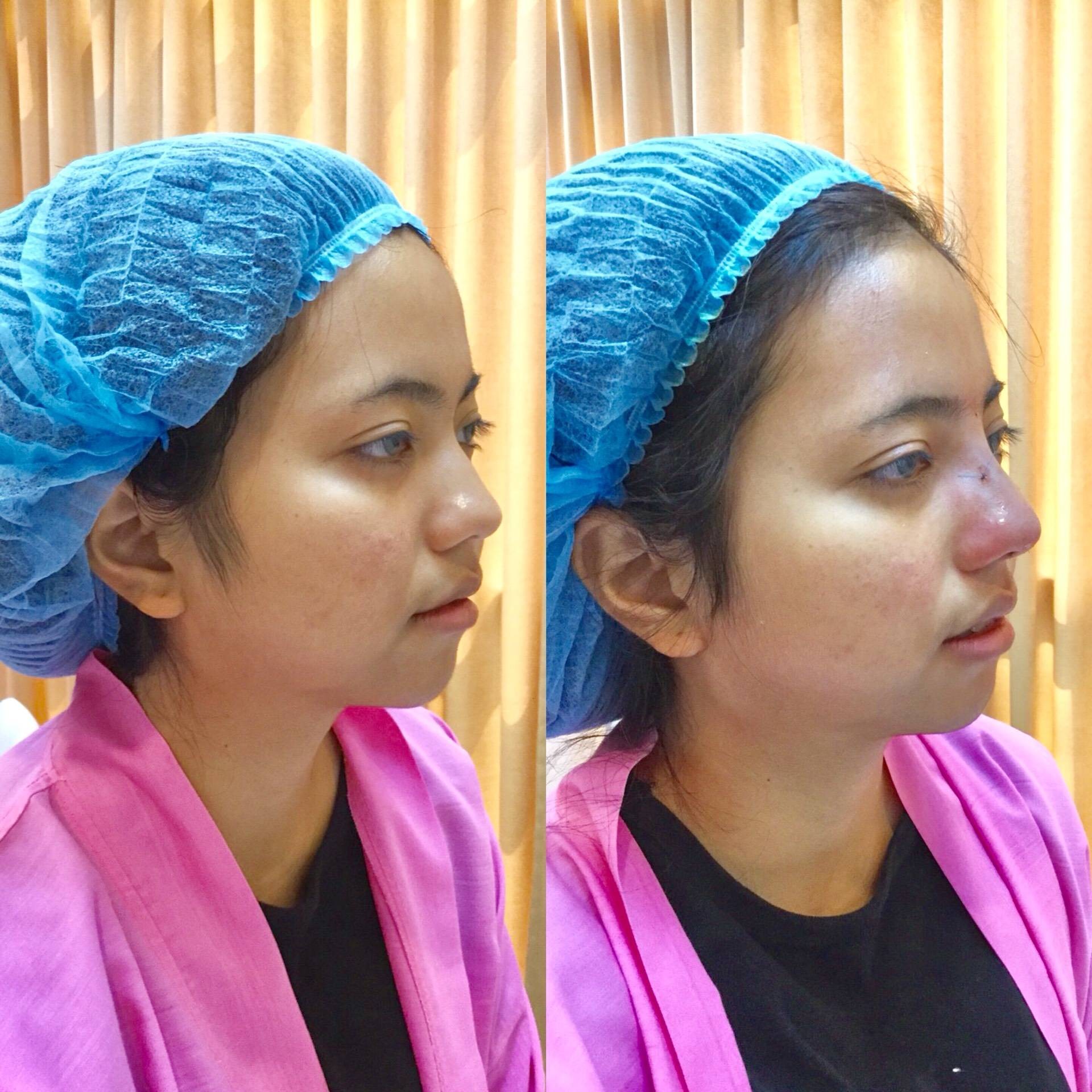 รีวิว AP Clinic Medical Group - วันนี้มารีวิวเสริมจมูก กับคุณหมอทิพย์AP ...