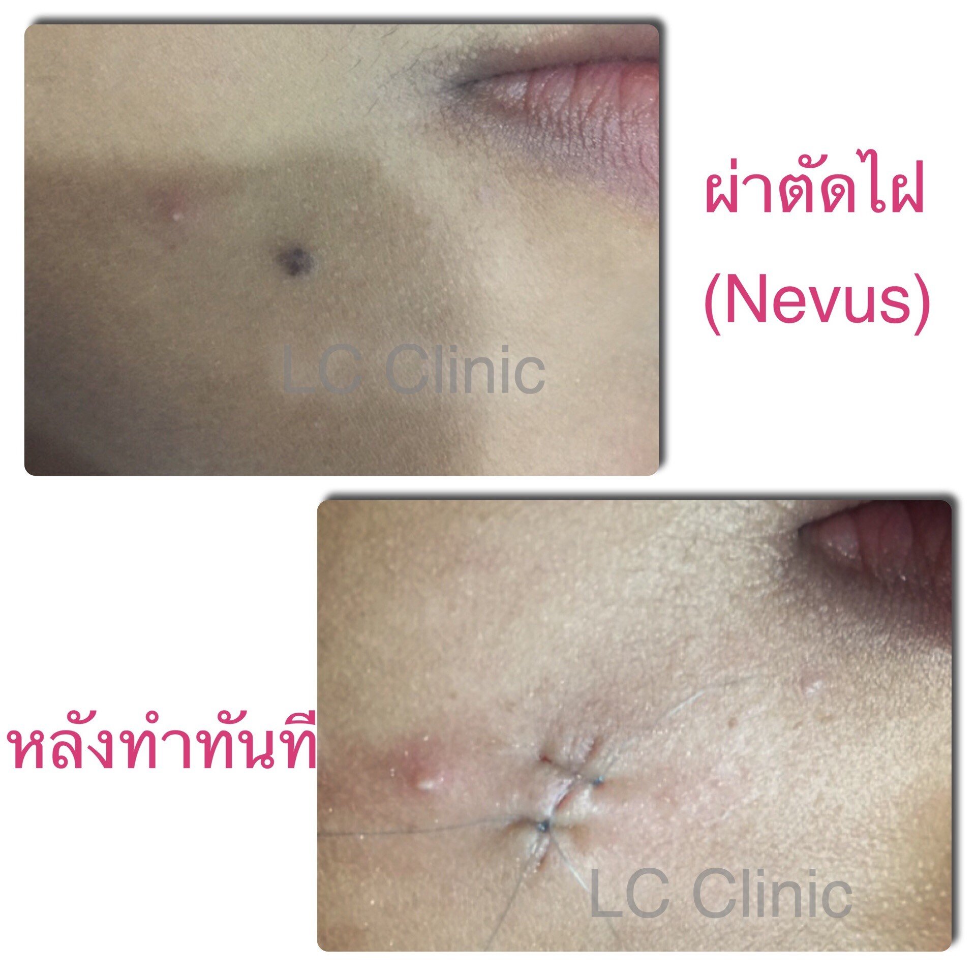 รีวิว LC Clinic (แอลซีคลินิก) ประโคนชัย จ.บุรีรัมย์ - ผ่าตัดไฝ กำจัดไฝ ...