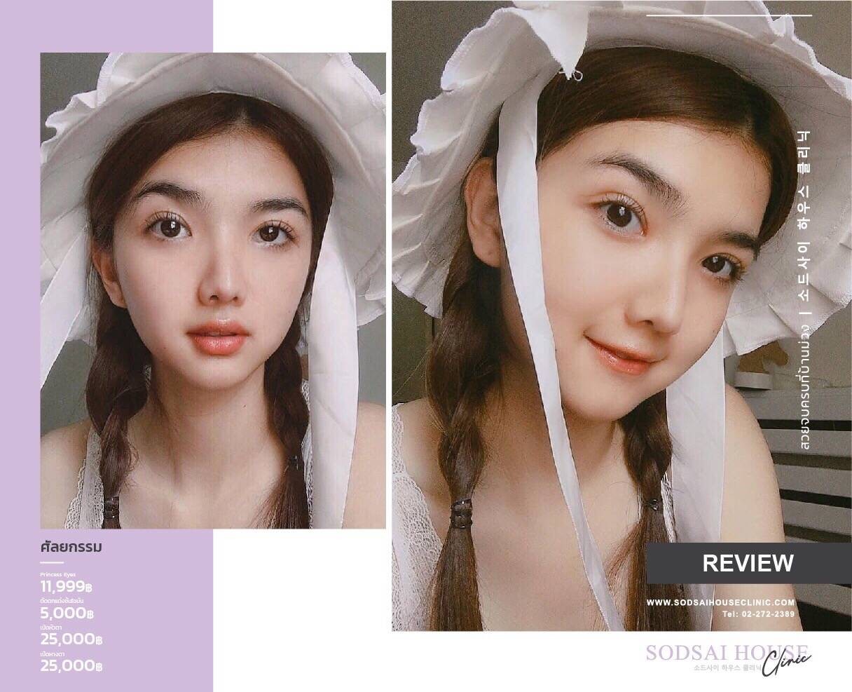 รีวิว Sodsai House Clinic วิภาวดี - อยากทำตาสองชั้น แต่ไม่อยากโป๊ะแตก ให้ใครจับได้! วันนี้เรามี ...