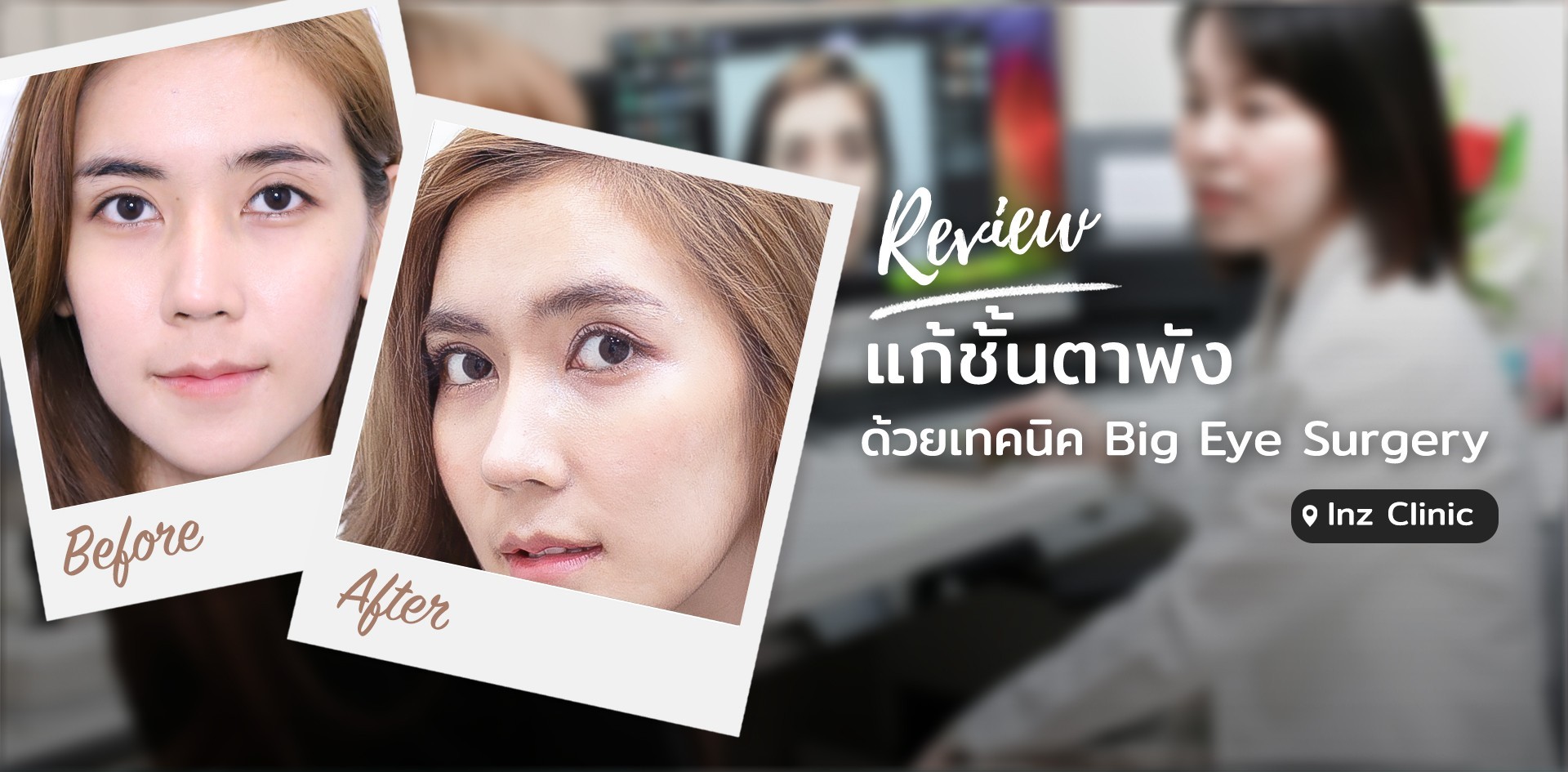 แก้ไขชั้นตาพัง ด้วยเทคนิค Big Eye Surgery