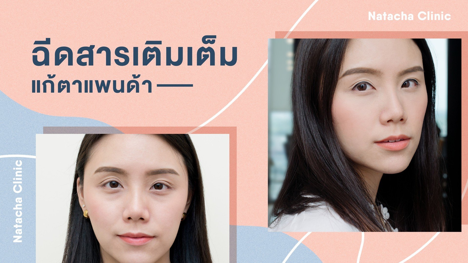 รีวิว ฉีดสารเติมเต็ม แก้ "ตาแพนด้า" ที่ Natacha Clinic