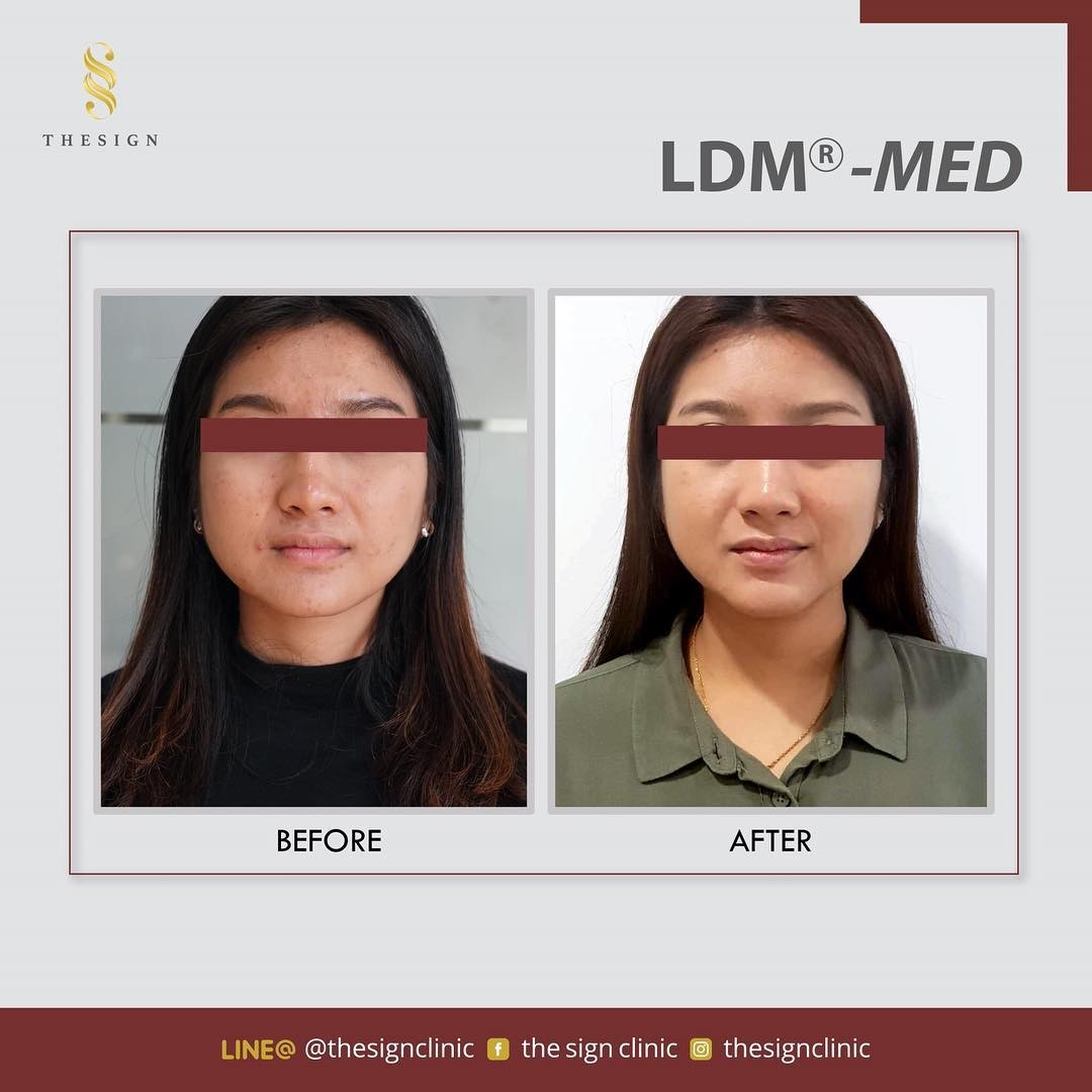ดีลส่วนลดพิเศษร้าน THE SIGN LDM facial treatment + Mask 1 session ราคา ...
