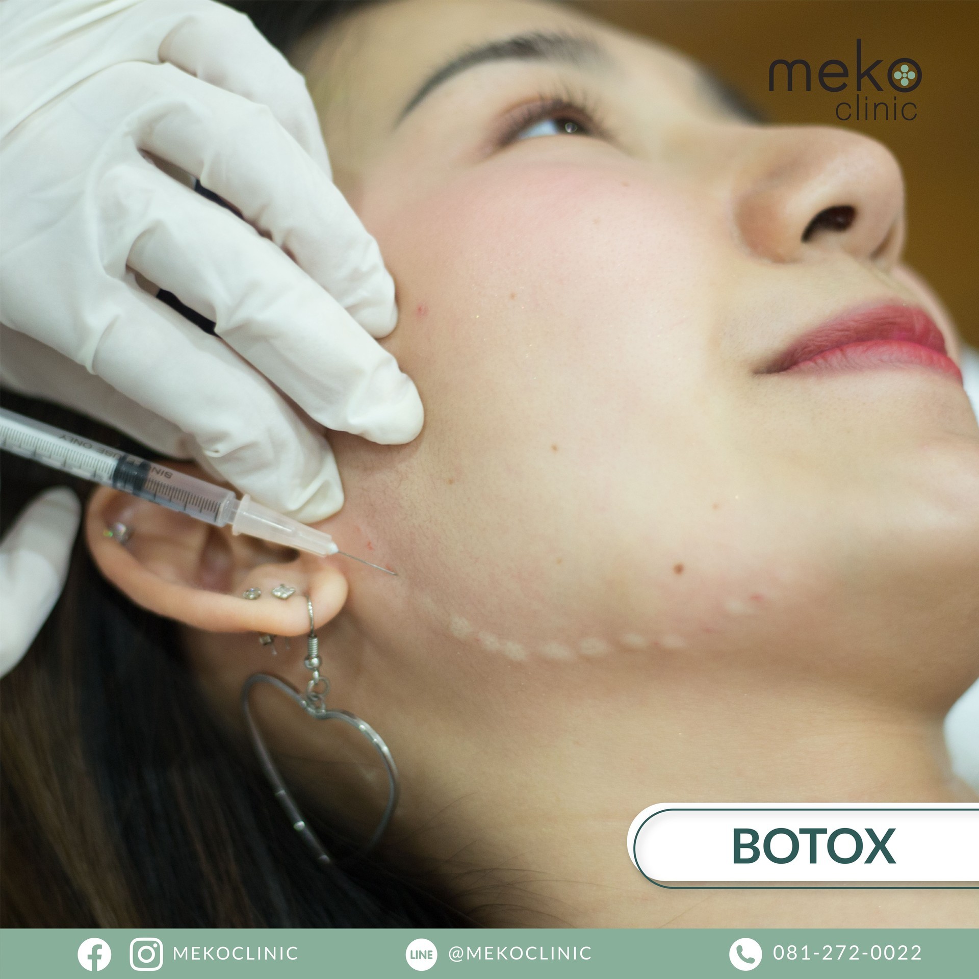 ดีลส่วนลดพิเศษร้าน Meko Clinic (เมโกะ คลินิก) Botulinum toxin (USA ...