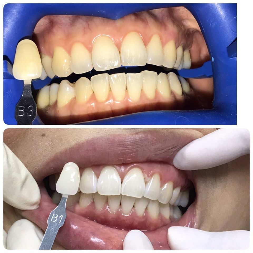 ดีลส่วนลดพิเศษร้าน LV Dental Clinic ดีลบิวตี้ ฟอกฟันขาว - Wongnai