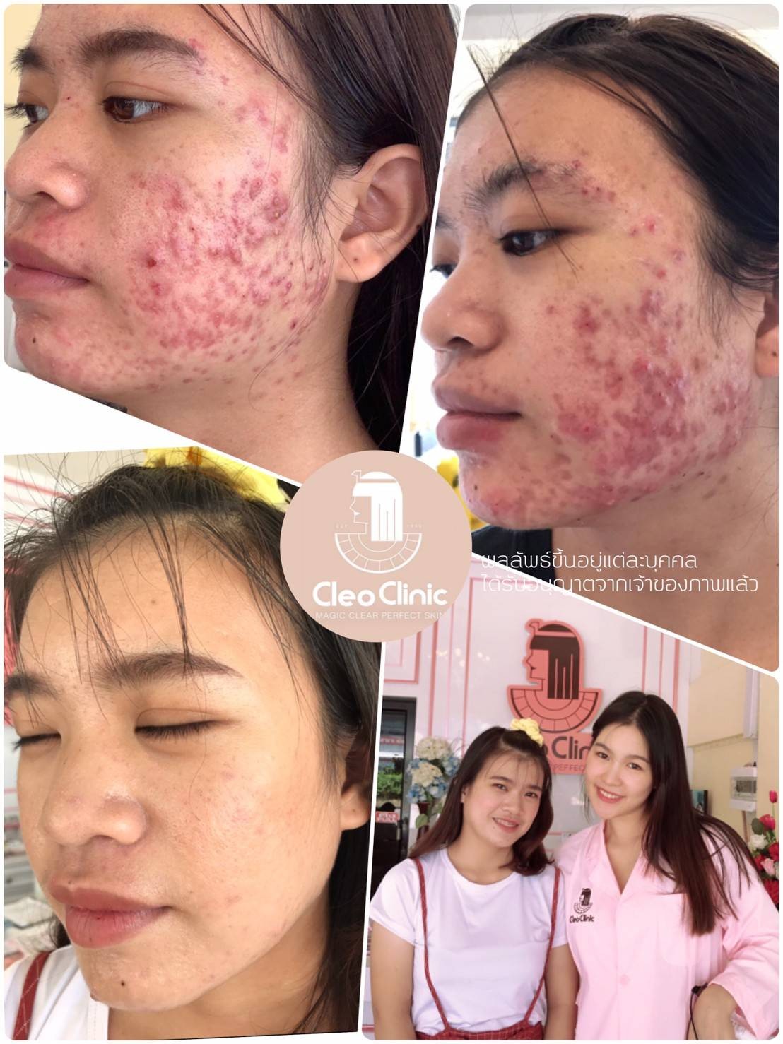 รีวิว CLEO SKIN สาขาฝาง ฝาง - แนะนำค่ะ