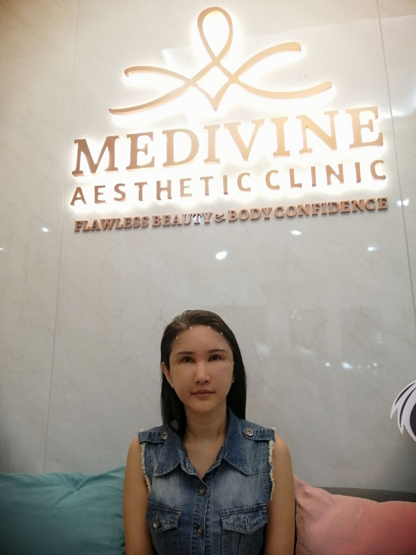 รีวิว Medivine Clinic - หลังฉีดไขมันหน้าเสร็จทันที