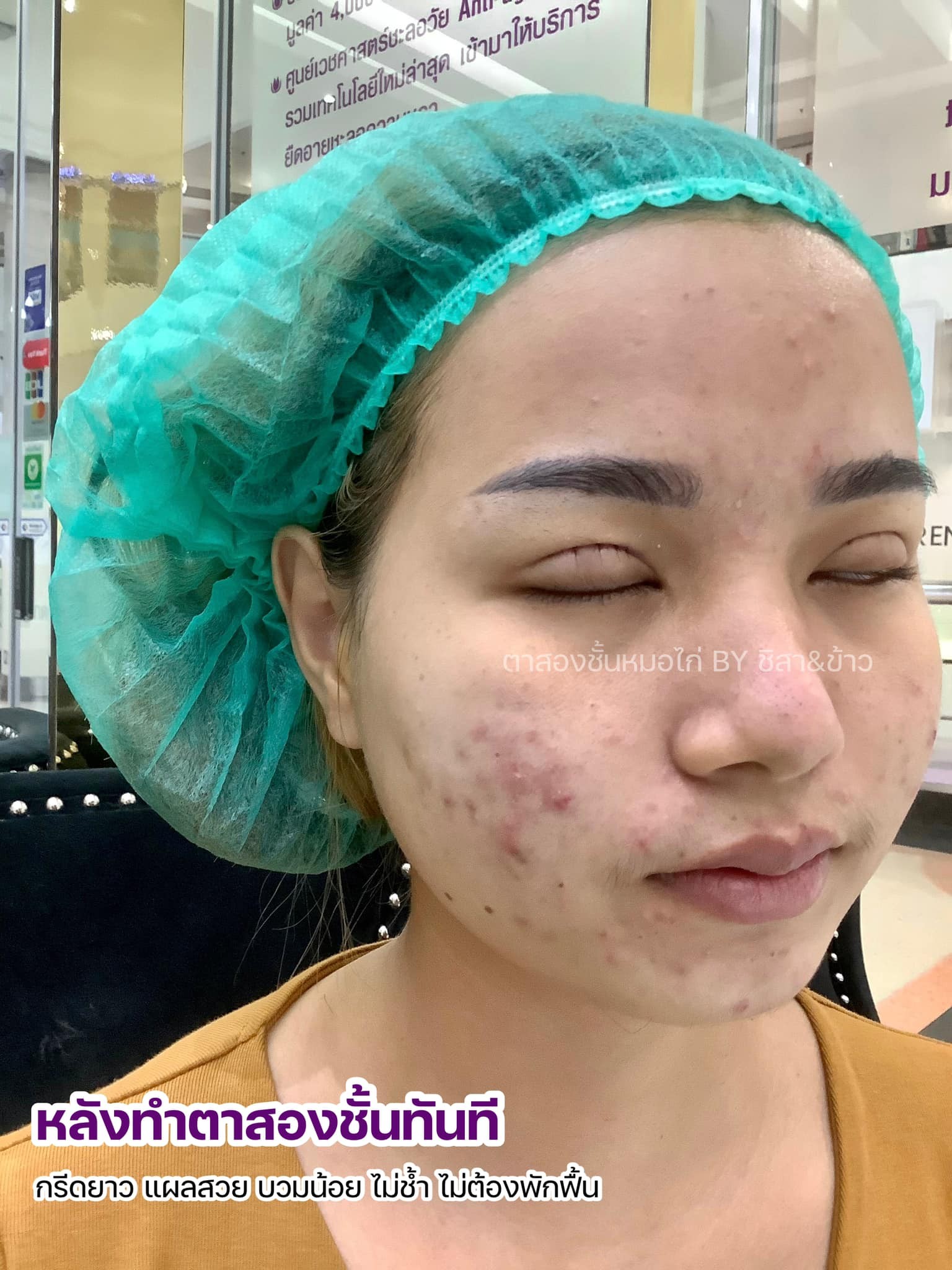 รีวิว At Medical Clinic สยามสแควร์วัน - สวยจริงบอกต่อ! หลังทำตาสองชั้น ...