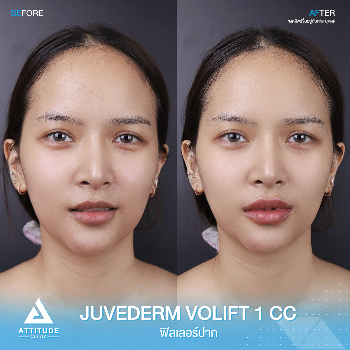 รีวิว ATTITUDE CLINIC เชียงราย - รีวิวฉีดฟิลเลอร์ปากด้วย 𝗝𝘂𝘃𝗲𝗱𝗲𝗿𝗺 𝗩𝗼𝗹𝗶𝗳𝘁 จำนวน 𝟭 𝗰𝗰 เติมเต็มปรับ ...