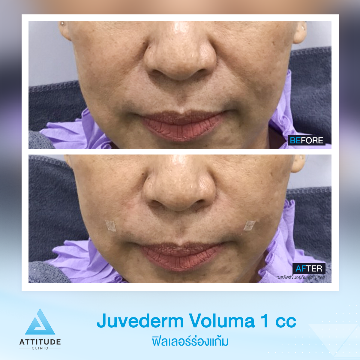 รีวิว Attitude Clinic ลำปาง - รีวิวฉีดฟิลเลอร์ร่องแก้มด้วย 𝗝𝘂𝘃𝗲𝗱𝗲𝗿𝗺 𝗩𝗼𝗹𝘂𝗺𝗮 จำนวน 𝟭 𝗰𝗰 เติมเต็ม ...