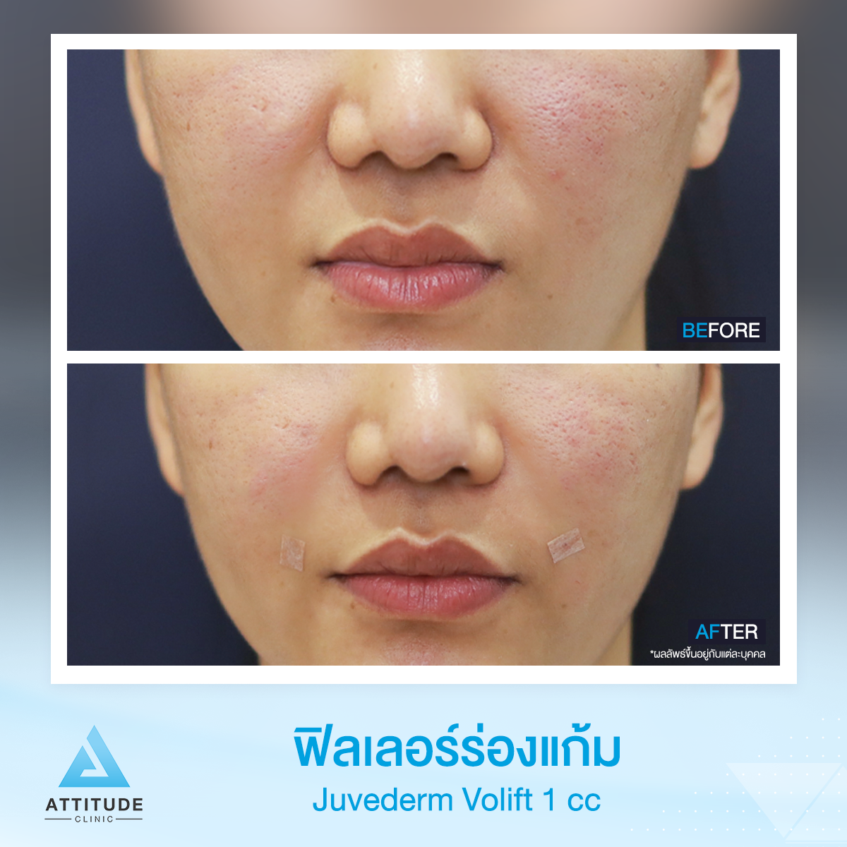 รีวิว ATTITUDE CLINIC เชียงราย - รีวิวฉีดฟิลเลอร์ร่องแก้ม 𝗝𝘂𝘃𝗲𝗱𝗲𝗿𝗺 𝗩𝗼𝗹𝗶𝗳𝘁 จำนวน 𝟭 𝗰𝗰 เติมเต็ม ...