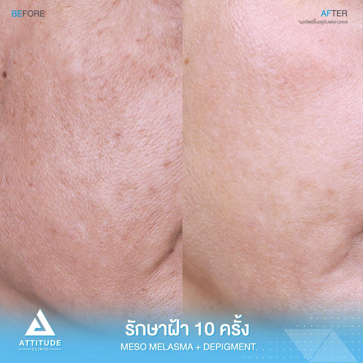 รีวิว ATTITUDE CLINIC เชียงราย - รีวิวรักษาฝ้าด้วยการ 𝗠𝗲𝘀𝗼 𝗠𝗲𝗹𝗮𝘀𝗺𝗮 ...