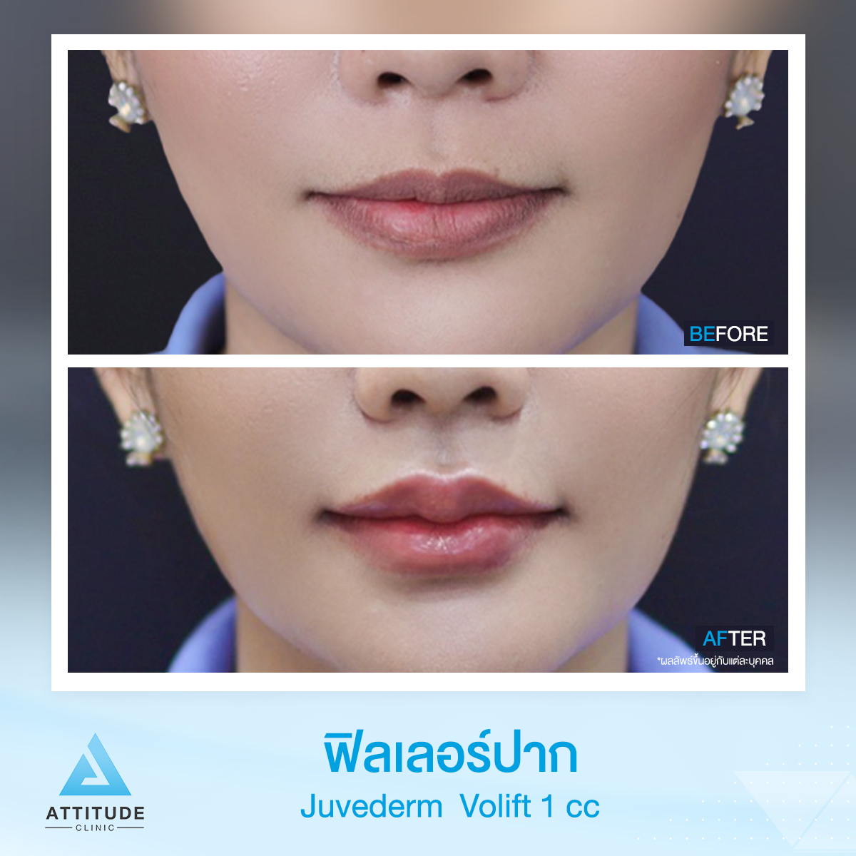 รีวิว ATTITUDE CLINIC เชียงใหม่ - รีวิวฉีดฟิลเลอร์ปาก Juvederm Volift จำนวน 1 cc เติมเต็มปากให้ ...