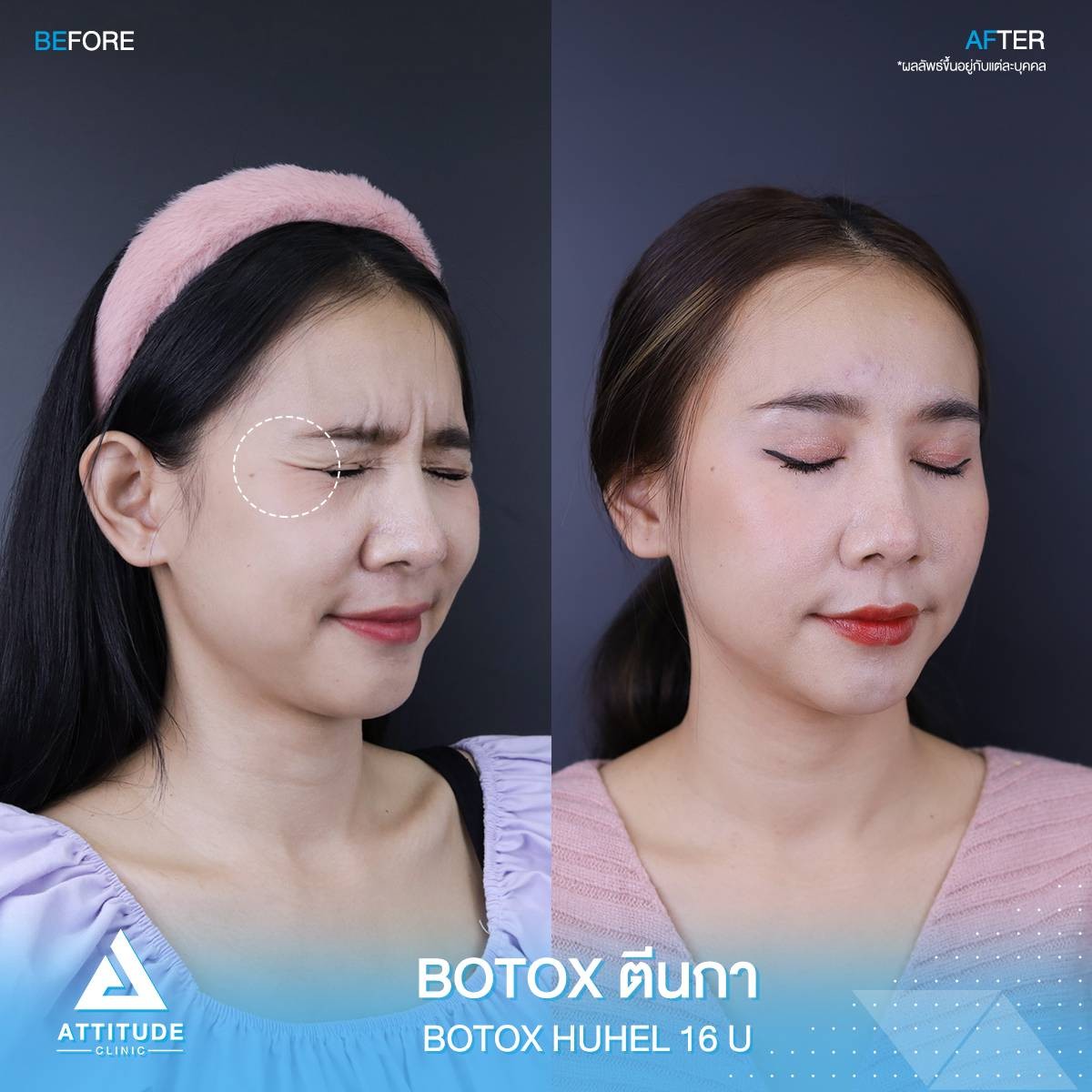 รีวิว ATTITUDE CLINIC เชียงราย - รีวิวฉีดโบท็อกซ์ลดริ้วรอย Upper Face ...