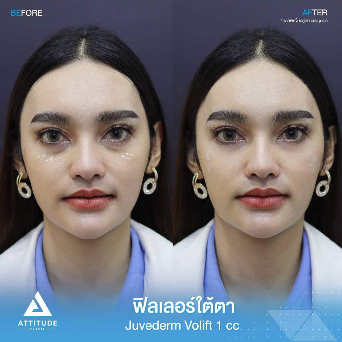 รีวิว ATTITUDE CLINIC เชียงใหม่ - รีวิวฉีดฟิลเลอร์ใต้ตา Juvederm Volift จำนวน 1 cc แก้ไขและเติม ...