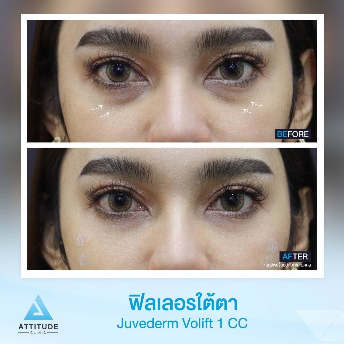 รีวิว ATTITUDE CLINIC เชียงราย - รีวิวฉีดฟิลเลอร์ใต้ตา Juvederm Volift จำนวน 1 cc แก้ไขและเติม ...