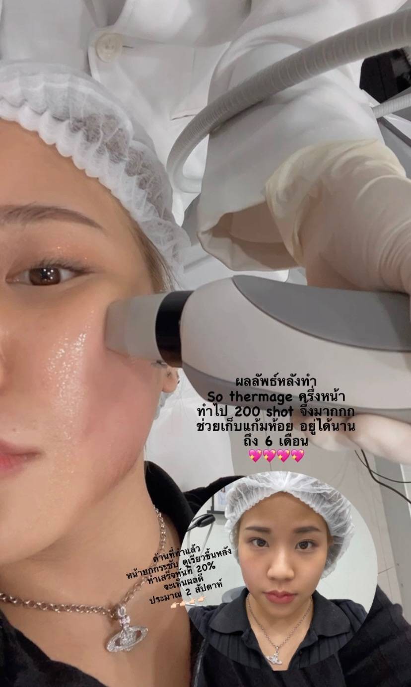 รีวิว Someko clinic - ทำ So thermage ครั้งแรกกับคุณหมอเบญที่ Someko ชอบมาก ทำไปทั้งหมด 200 shots ...