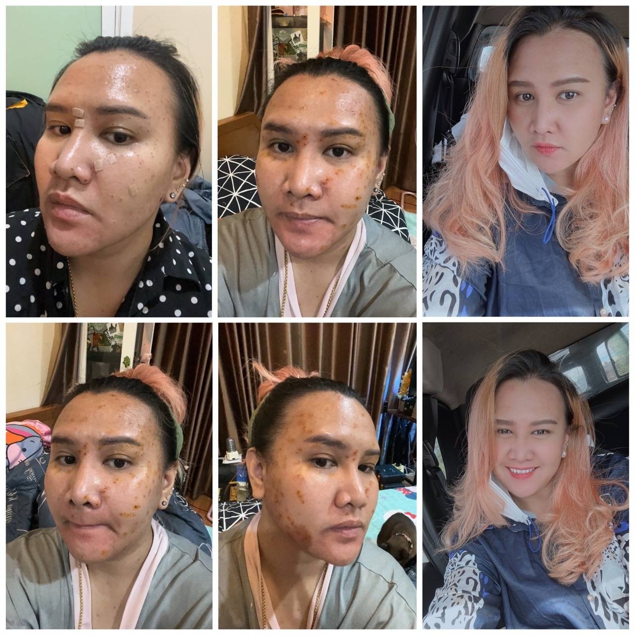 รีวิว Olivia Clinic สัมมากรเพลส รามคำแหง110 - เคลียร์หน้าใส (เลเซอร์ติ่งเนื้อ)