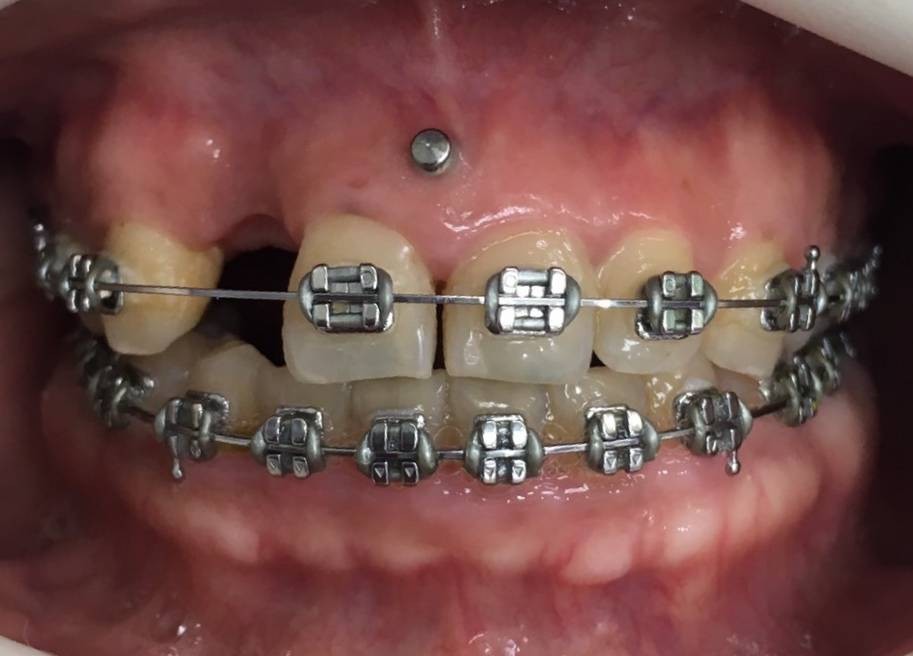 รีวิว Double Smile Dental Clinic รามอินทรา กม.14 - ประทับใจหมอเก่งมากๆครับ