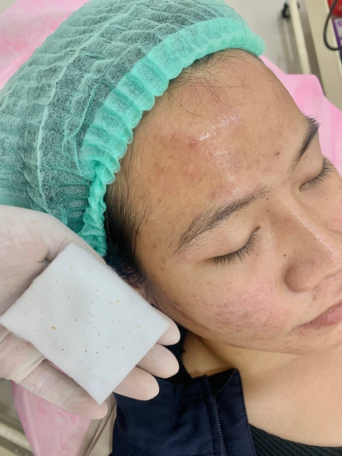 รีวิว Olivia Clinic สัมมากรเพลส รามคำแหง110 - กดสิว - Wongnai