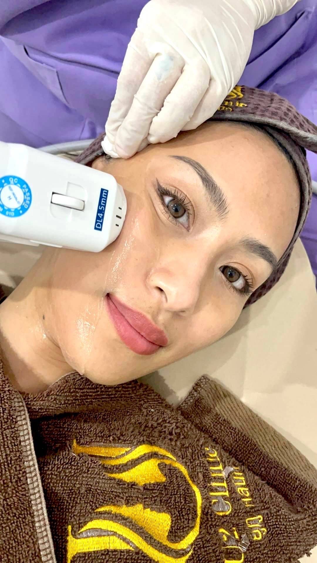 รีวิว U2clinic - ยกกระชับ ปรับรูปหน้าด้วย hifu แบบไม่จำกัดชอตที่ u2 Clinic