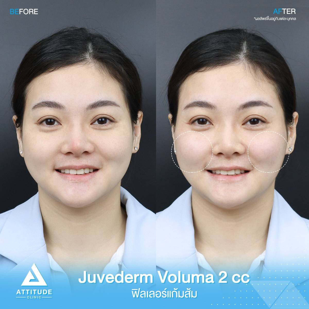 รีวิว Attitude Clinic ลำปาง - รีวิวฉีดฟิลเลอร์แก้มส้ม Juvederm Voluma จำนวน 2 cc เติมเต็มช่วง ...