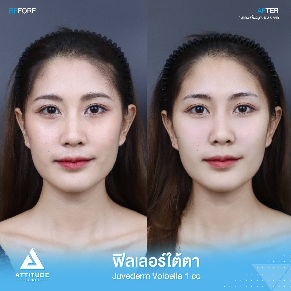 รีวิว ATTITUDE CLINIC เชียงราย - รีวิวฉีดฟิลเลอร์ใต้ตา Juvederm Volbella 1 cc เติมเต็มร่องใต้ตา ...