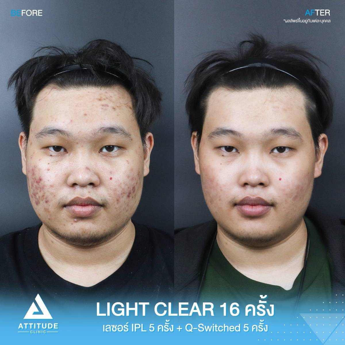 รีวิว Attitude Clinic ห้วยขวาง - รีวิวรักษาสิวครบวงจร Light Clear 16 ...