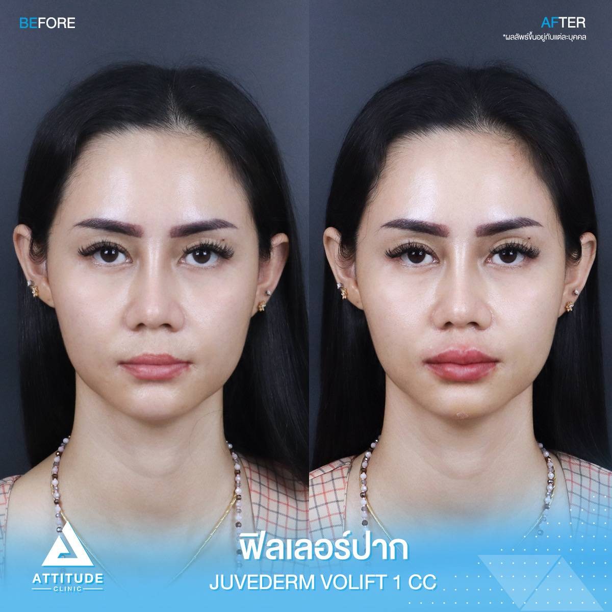 รีวิว ATTITUDE CLINIC เชียงใหม่ - รีวิวฉีดฟิลเลอร์ปาก Juvederm Volift จำนวน 1 cc เติมเต็มปากสวย ...
