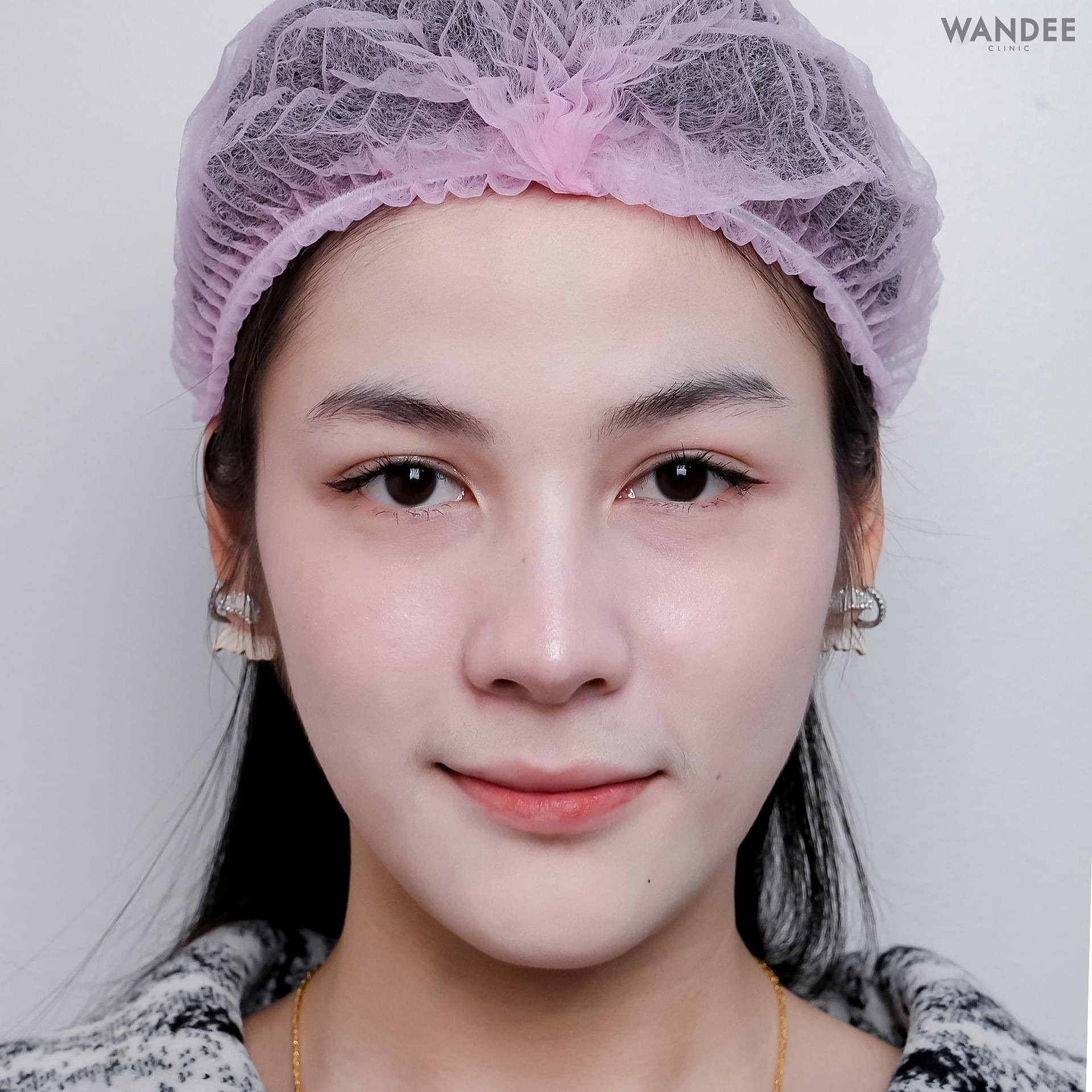 รีวิว WANDEE CLINIC (วันดีคลินิก) พัทยา ชลบุรี - Filler ปาก 💋