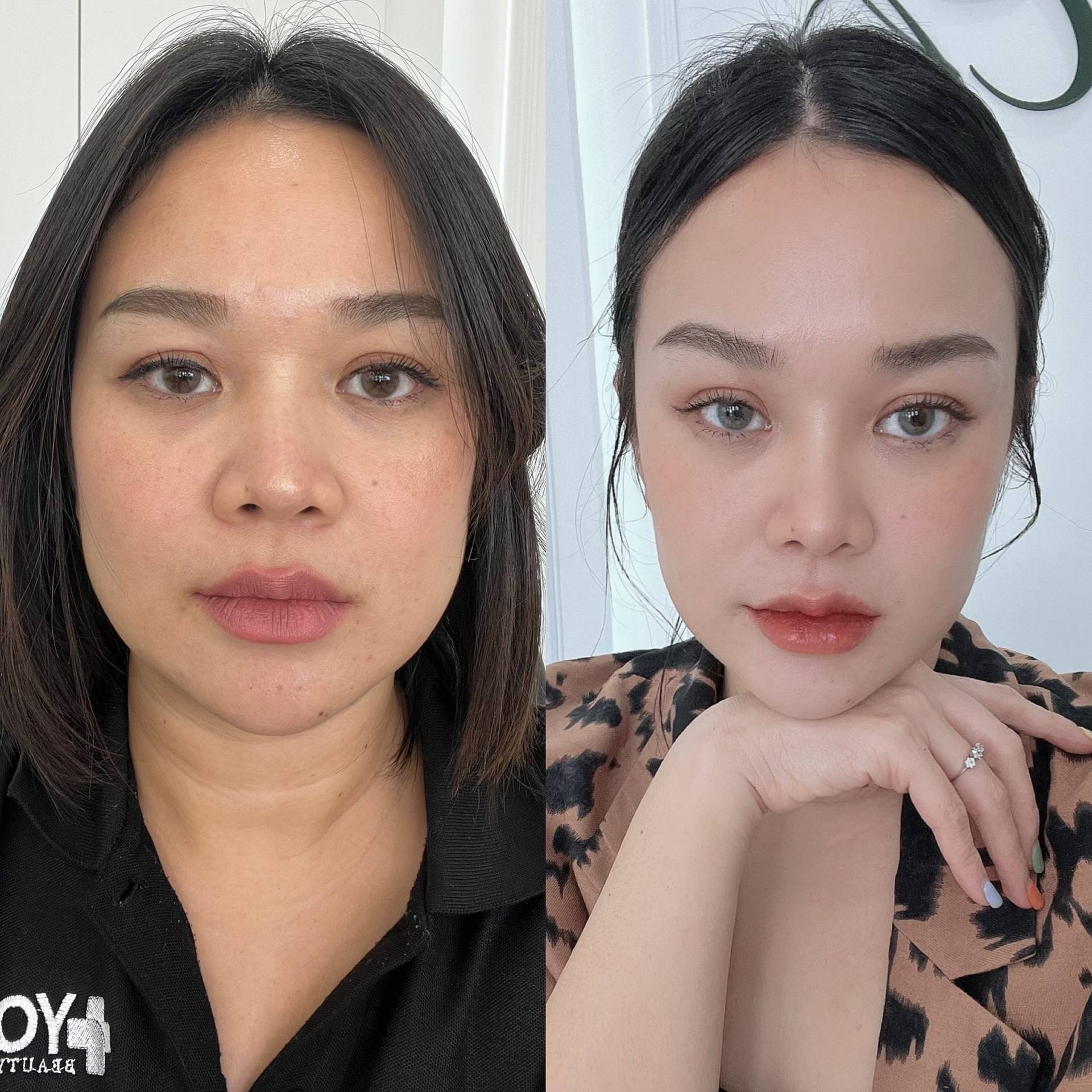 รีวิว Chic Clinic เชียงราย - โบท็อกซ์เชียงราย