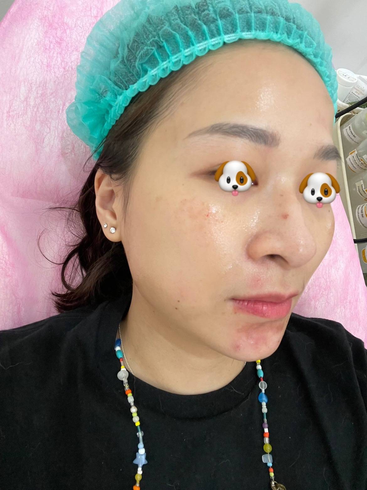 รีวิว Olivia Clinic สัมมากรเพลส รามคำแหง110 - รีวิวฉีดสิวไม่มีหัว