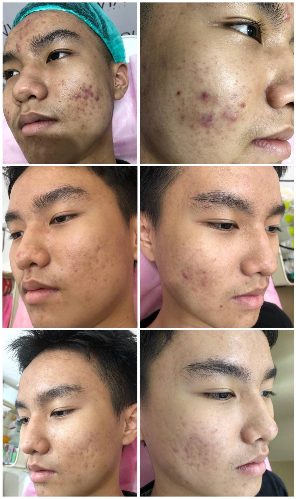 รีวิว Olivia Clinic สัมมากรเพลส รามคำแหง110 - รักษาสิว+มาเด้+โรสเบลล่า