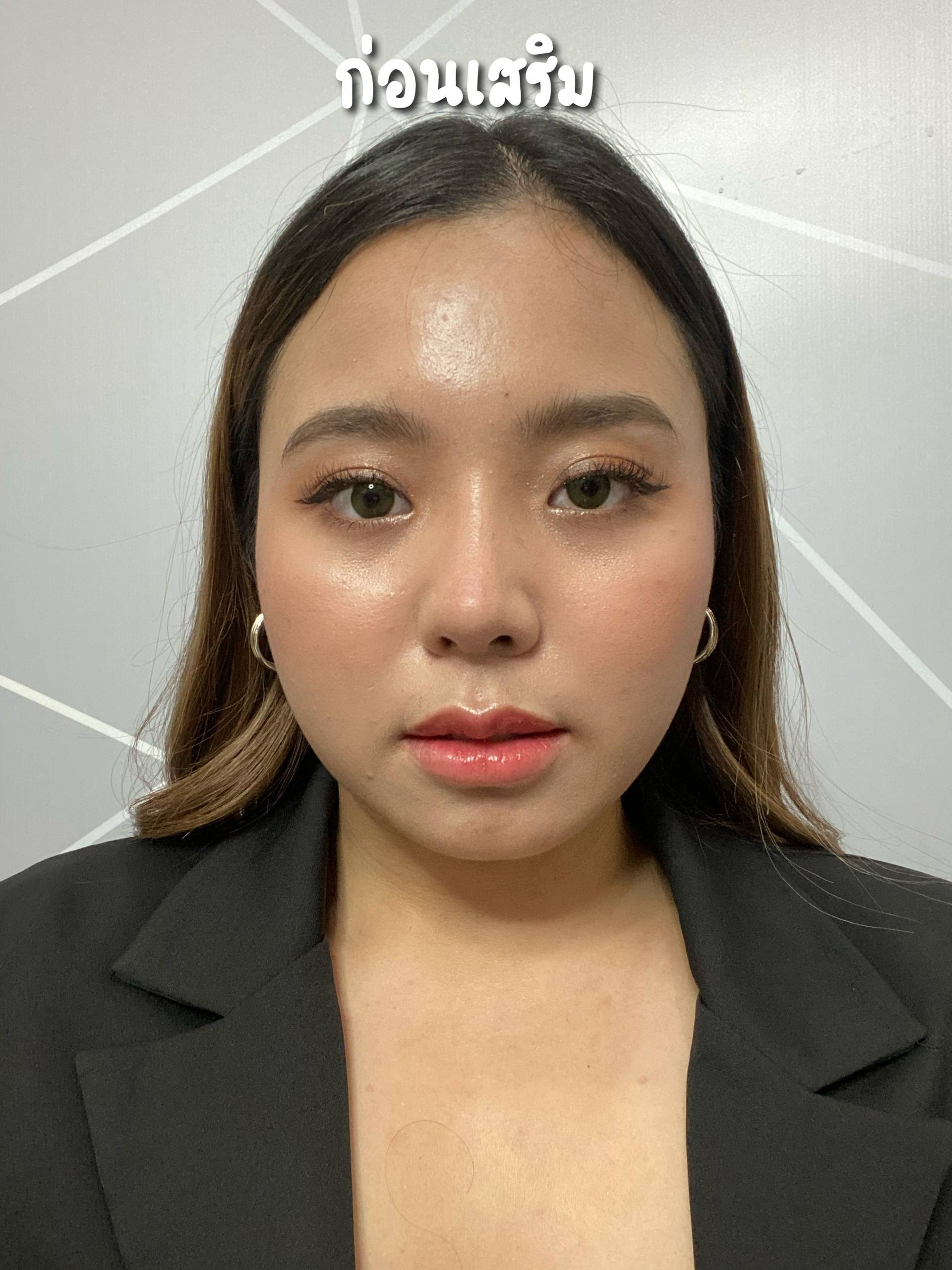 รีวิว Saint Thonglor - รีวิวเสริมคางกับคุณหมอโป้งครบ 6 เดือนค่า