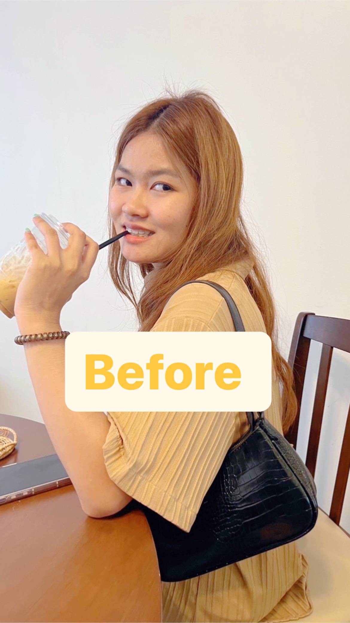 ศัลยกรรมจมูก • ก่อนทำ หน้าแบนไม่มีมิติ ร้าน Showtime Clinic รัชดา