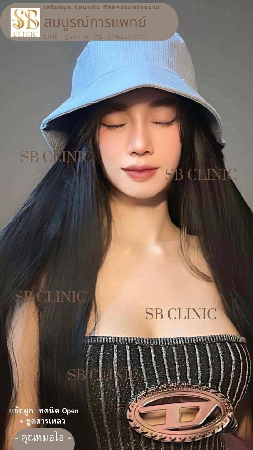 ร้าน SB Clinic (สมบูรณ์การแพทย์)ขอนแก่น เสริมจมูกขอนแก่น สมบูรณ์การแพทย์