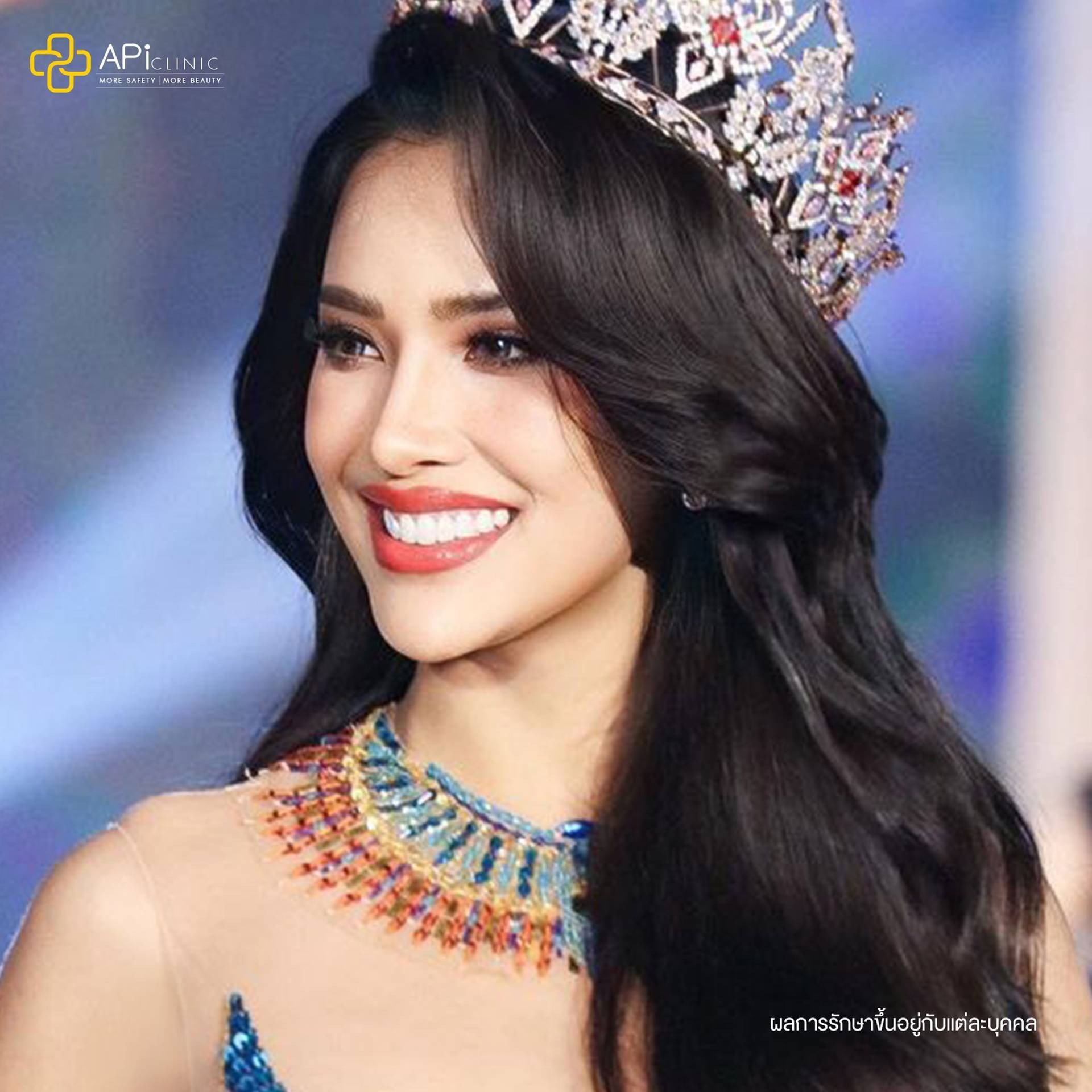 รูป APi Clinic เสริมจมูกเทคนิคเกาหลี by หมอต้น AF