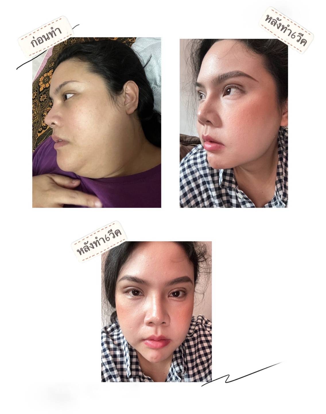 รีวิว Amara Liposuction & Body Contouring Center (Amara Clinic) รัช ...