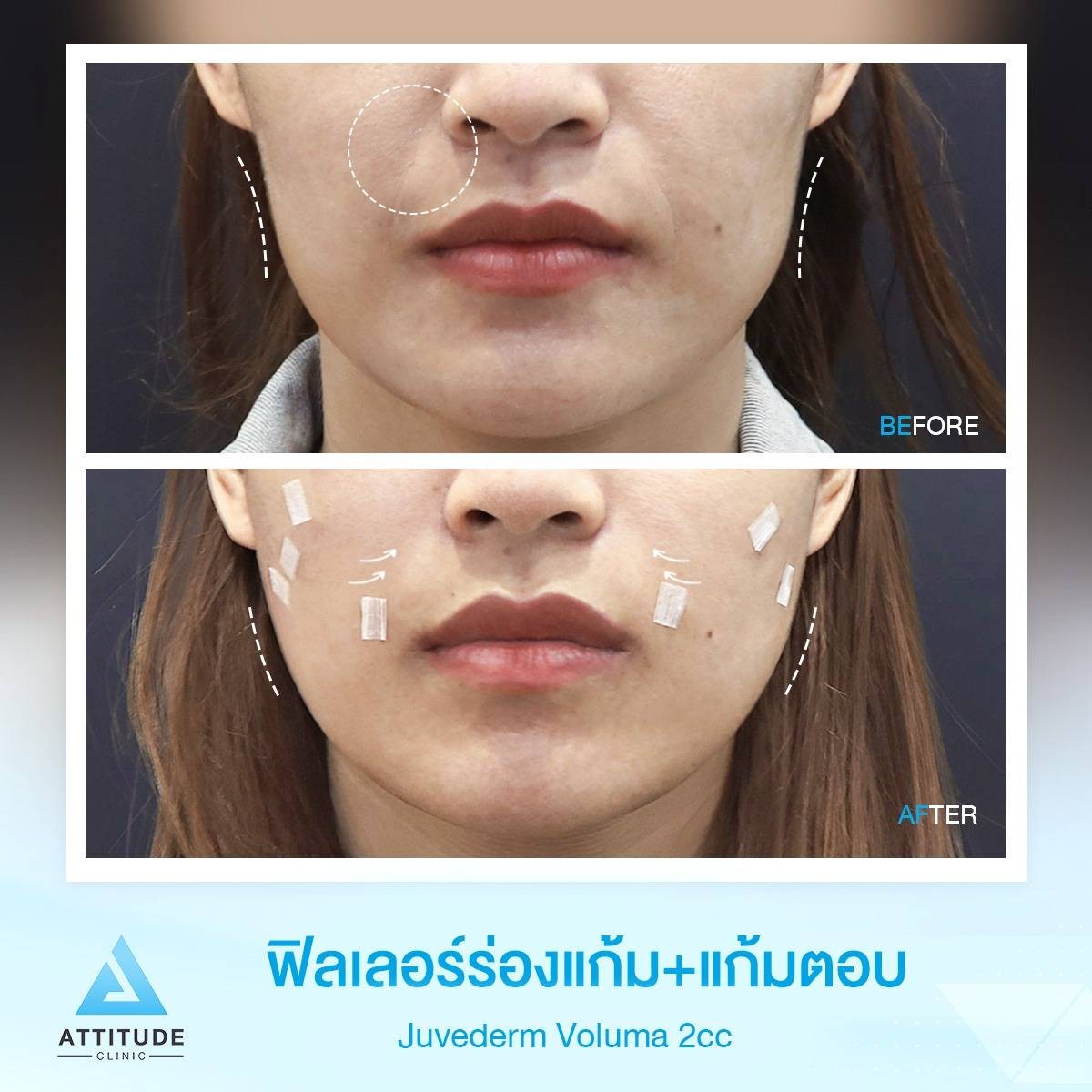 รีวิว ATTITUDE CLINIC เชียงใหม่ - รีวิวฉีดฟิลเลอร์ร่องแก้ม แก้มตอบ Juvederm Voluma 2 cc เติมเต็ม ...