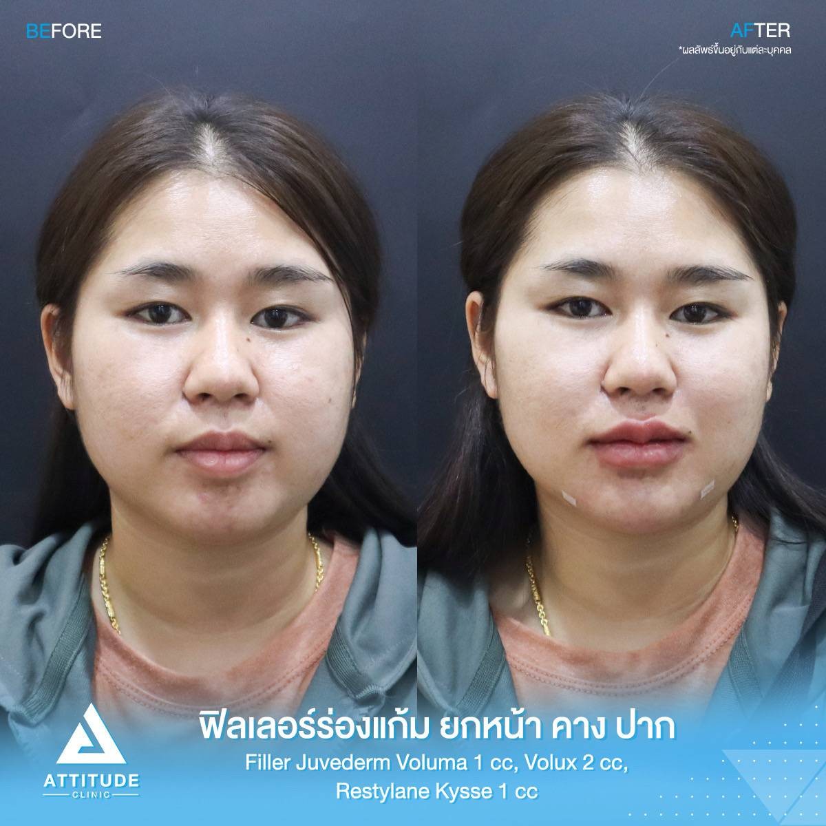 รีวิว ATTITUDE CLINIC เชียงราย - รีวิวฉีดฟิลเลอร์ร่องแก้ม ยกหน้า Juvederm Voluma 1cc เติมปาก ...