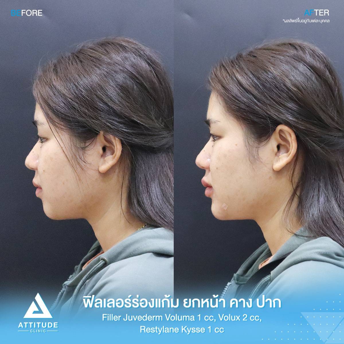 รีวิว Attitude Clinic ห้วยขวาง - รีวิวฉีดฟิลเลอร์ร่องแก้ม ยกหน้า Juvederm Voluma 1cc เติมปาก ...