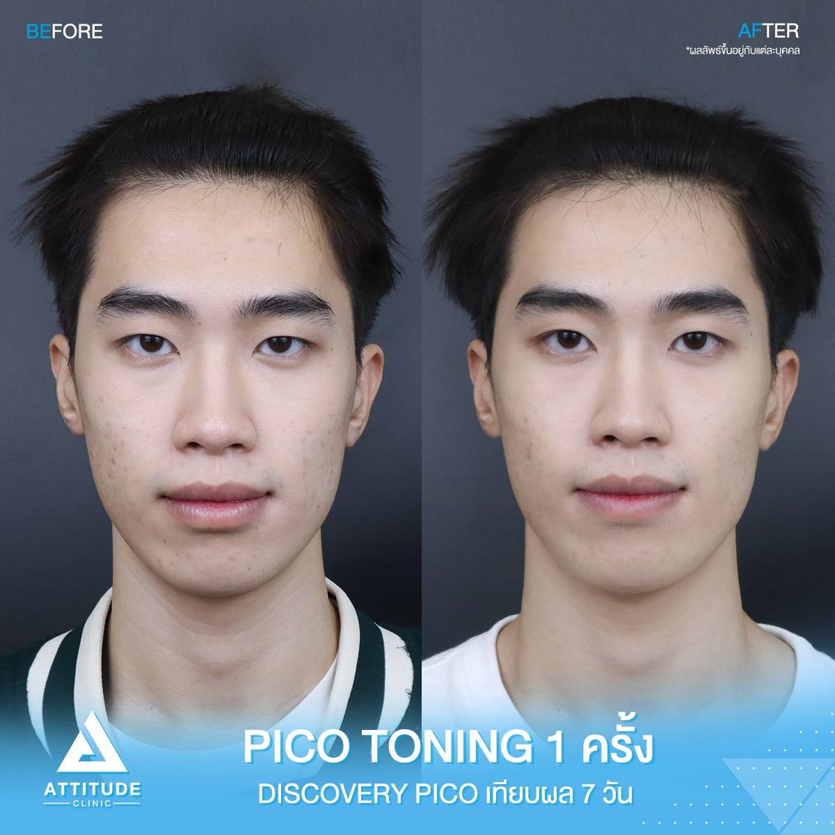 รีวิว ATTITUDE CLINIC เชียงใหม่ - รีวิวรักษารอยสิว Discovery Pico โหมด Toning 1 ครั้ง ของน้อง ...